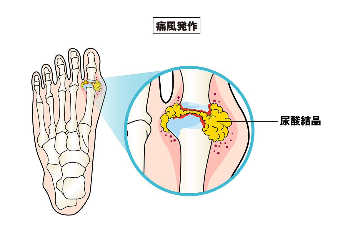 高尿酸血症が「痛風」を引き起こす仕組み 足の親指の付け根が腫れて靴が履けない…尿酸値が正常値でも発作が起こる理由とは【専門医が解説】 | マネーポストWEB - Part 2
